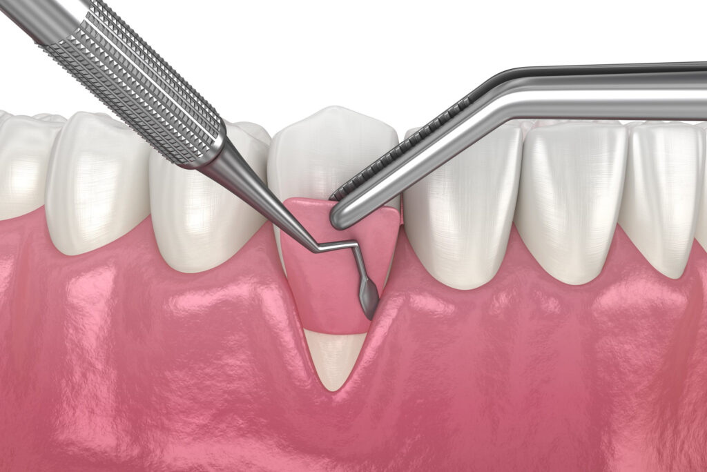 Failed Gum Graft? Here Is What to Do - Dental 3DU